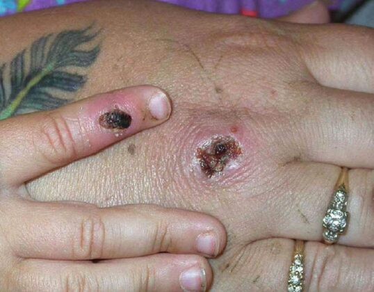 What is mpox? A microbiologist explains what’s known about this ...